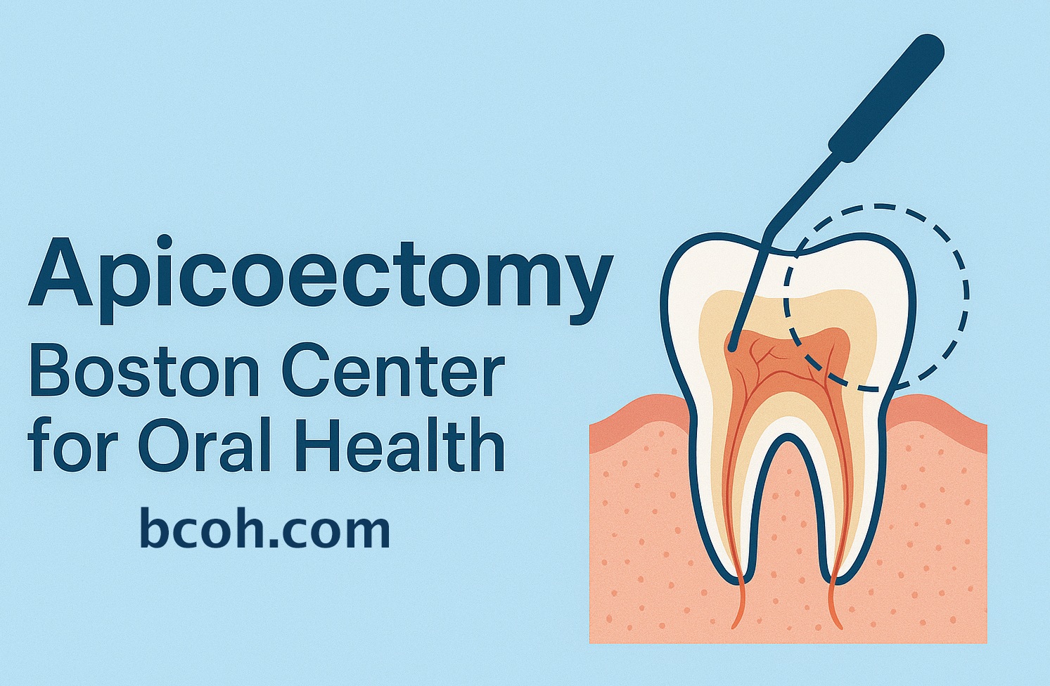 Apicoectomy | Boston Center for Oral Health